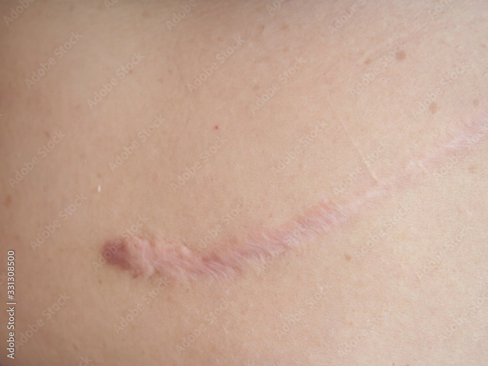 Closeup keloid scars on stomach skin after from surgery appendix ...