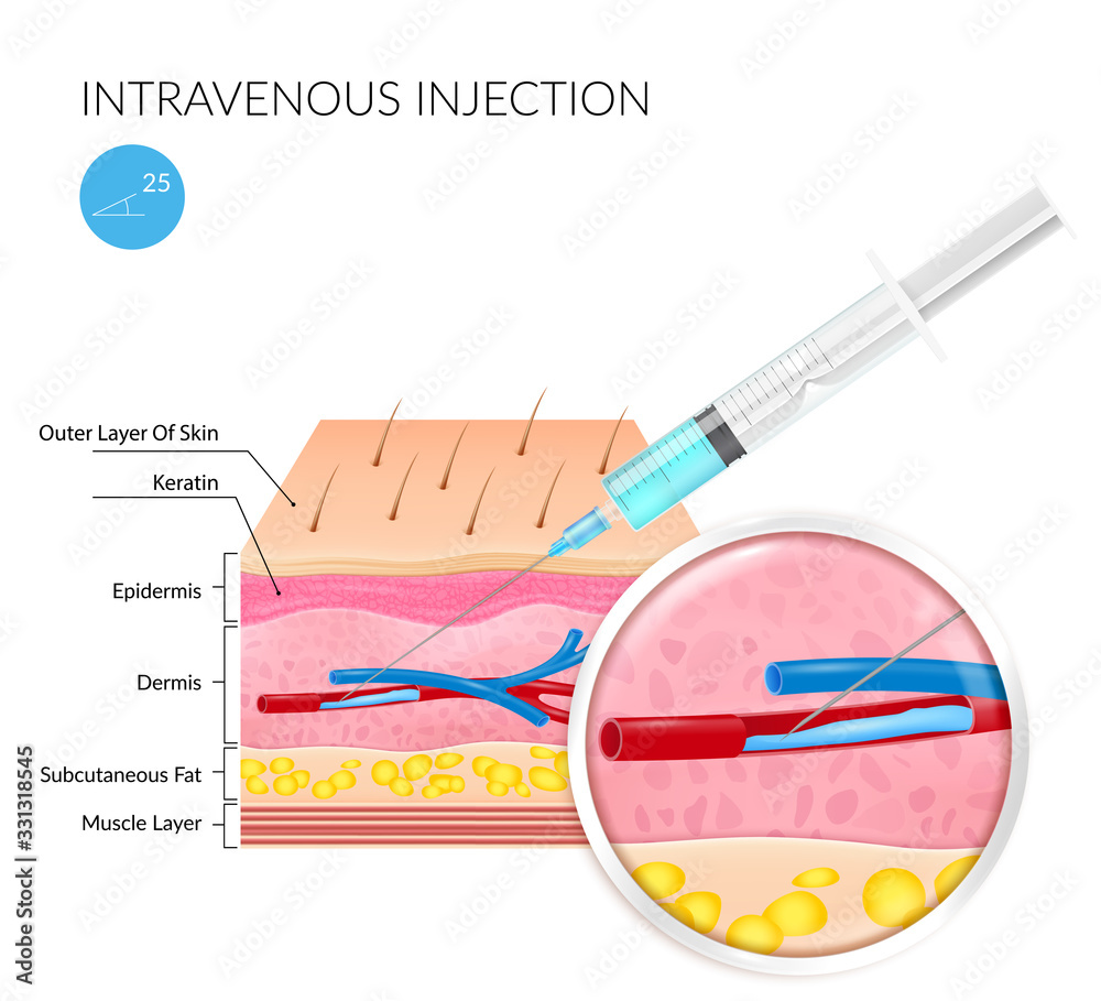 Realistic image of Intravenous injection on a white background with the ...