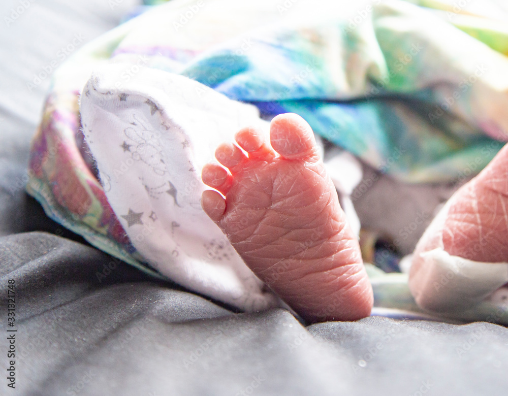 Newborn baby foot with dry, wrinkled, cracked, peeling skin. Overdue so ...