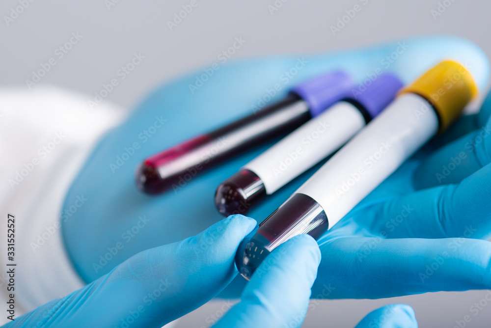 man's hand holding blood in a test tube close up, physical examination ...