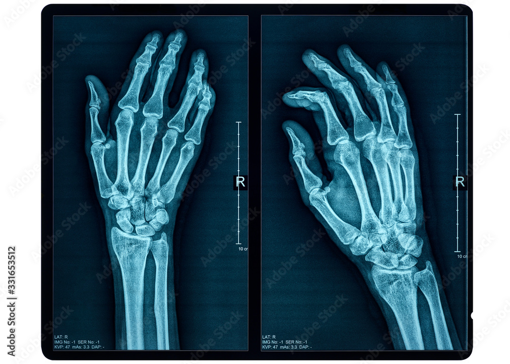 Hand X-ray Stock Photo | Adobe Stock