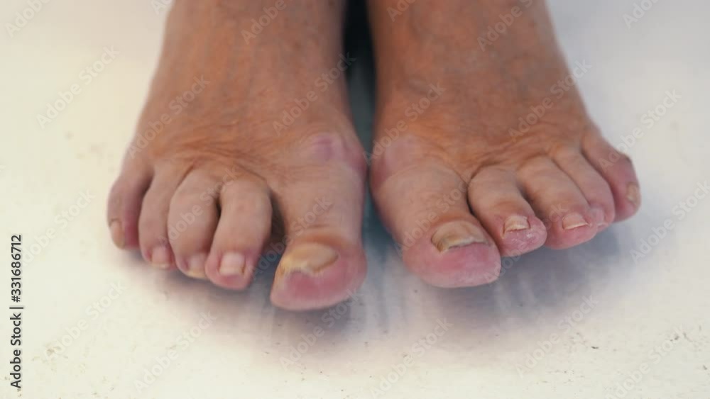 Female feet with fungus on the toes close-up. Toes with fungus. Old ...