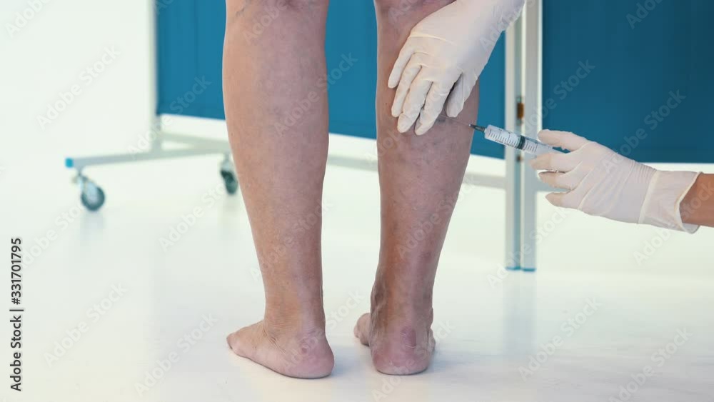 A close-up shot of an elderly woman's varicose veins. An injection into ...