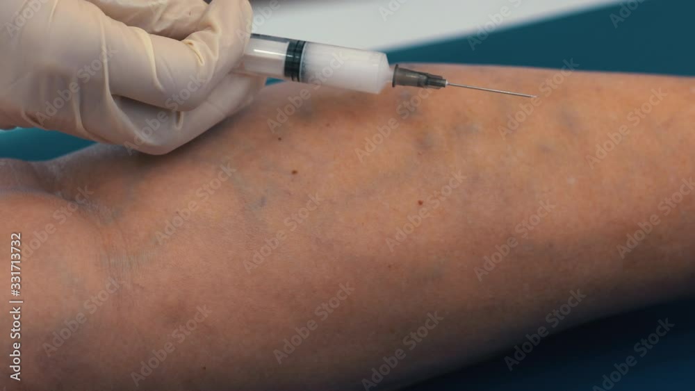 Vidéo Stock Treatment of varicose veins with injections. An injection ...