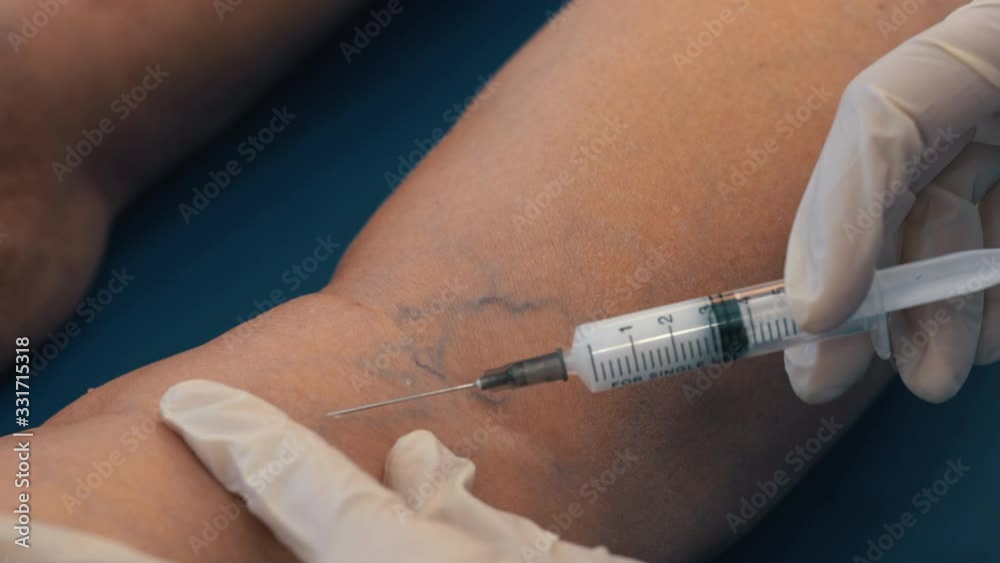 Treatment of varicose veins with injections. An injection into a vein ...