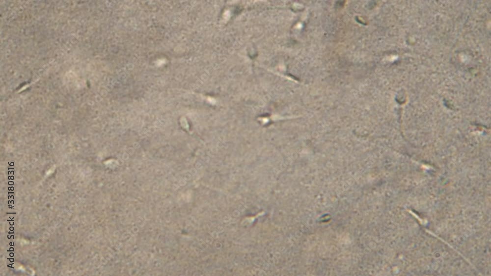 Microscopy of human sperm . Magnification 300x moving of spermatozoides ...