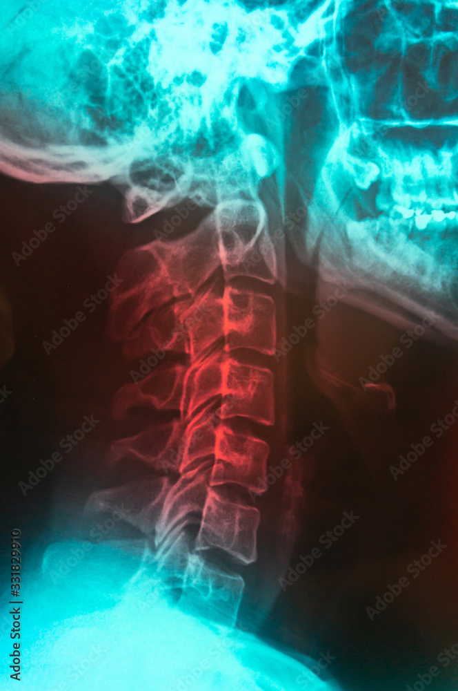 Cervical spine skeleton x-ray film of a patient with military neck or ...