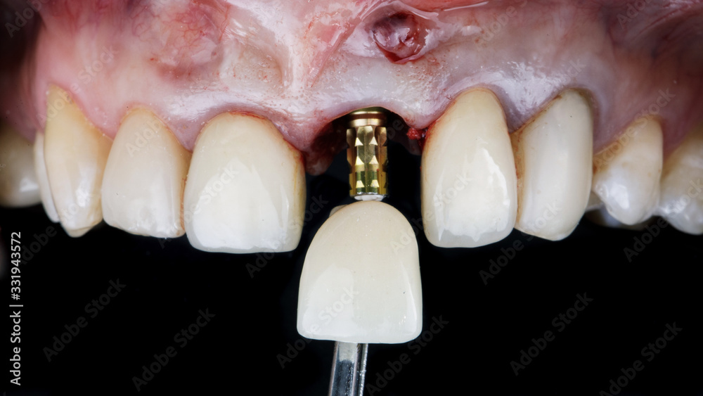 installation and fitting of a temporary crown on an abutment foto de ...