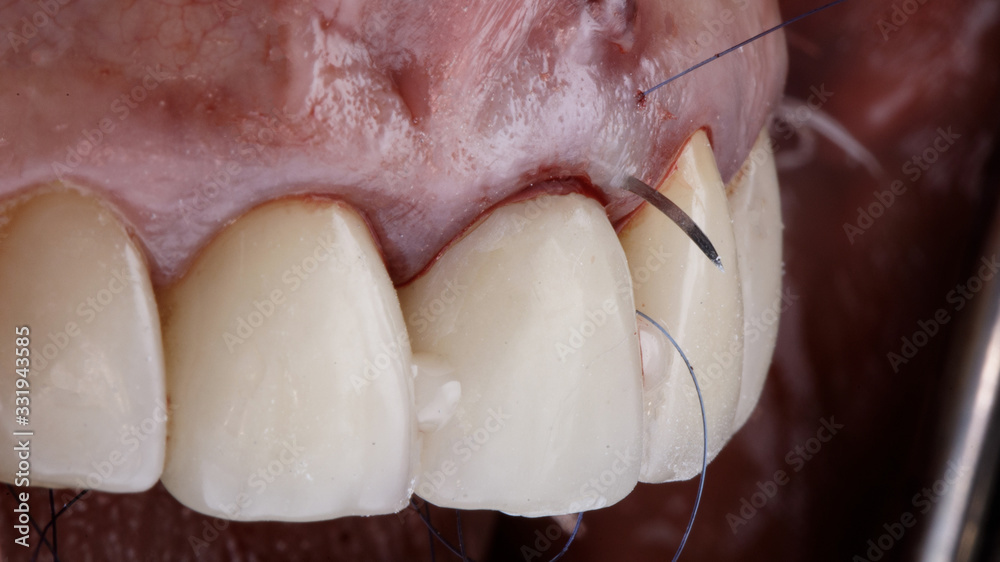 suturing the gums and fixing the crown after implantation Stock Photo ...