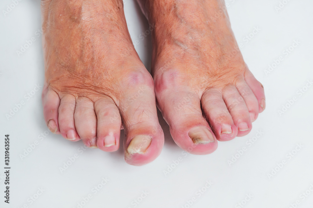 Nail fungus on the toes of an elderly woman's feet close-up on a white ...
