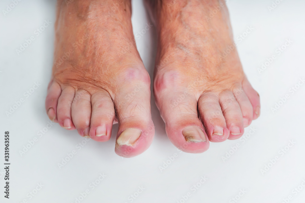 Nail fungus on the toes of an elderly woman's feet close-up on a white ...