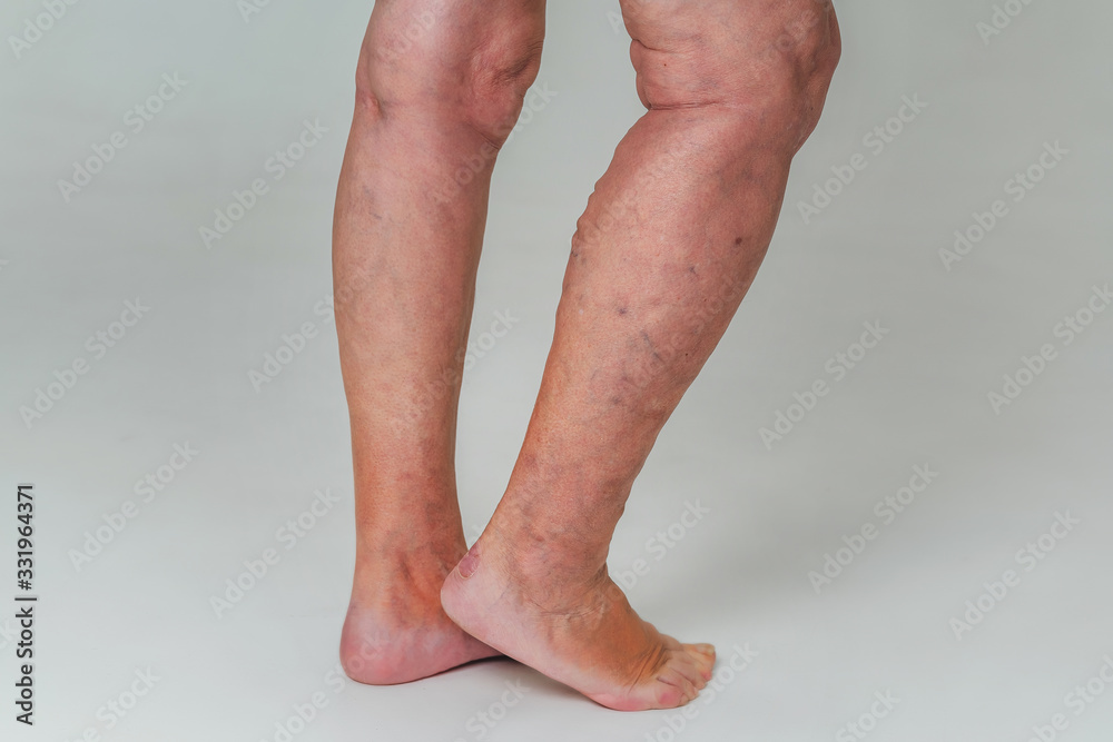 Varicose veins in an elderly woman. Inflamed dilated veins in the legs ...