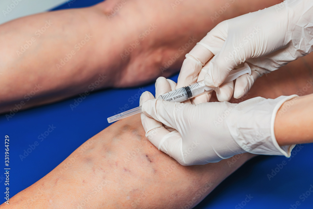 Injections into the veins of an elderly woman's leg close-up. Doctor's ...