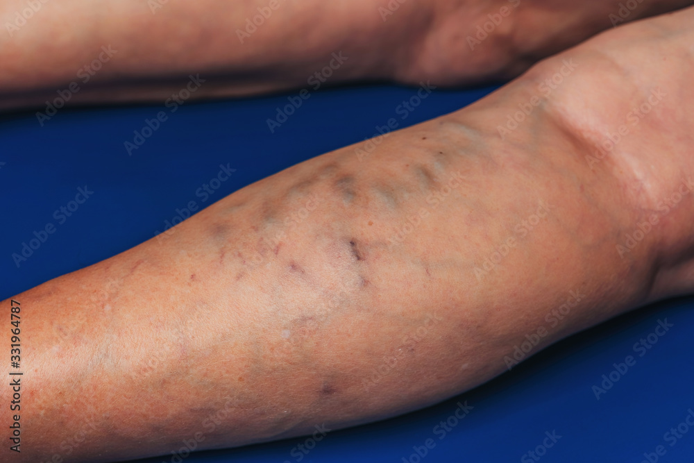 Foto de Varicose veins in an elderly woman. Inflamed dilated veins in the legs. Varicose veins ...