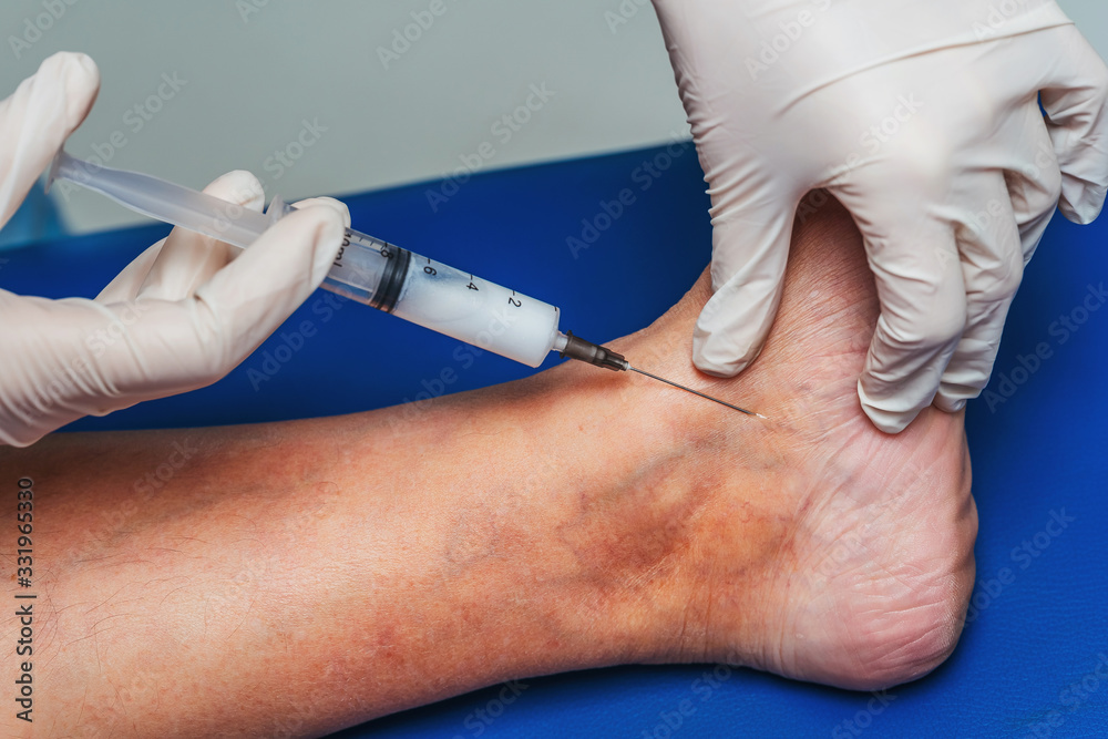 Injections into the veins of an elderly woman's leg close-up. Doctor's ...
