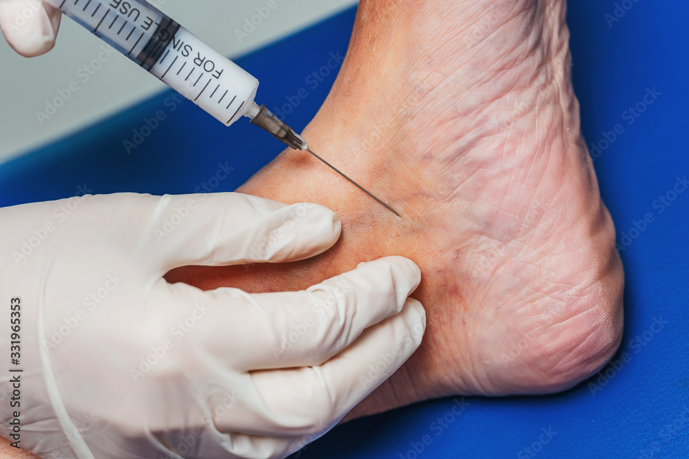 Injections into the veins of an elderly woman's leg close-up. Doctor's ...