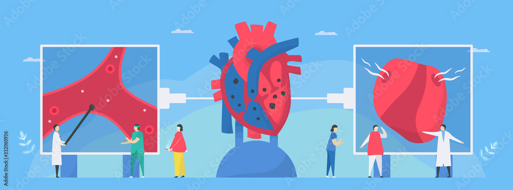 Cardiology vector illustration. This disease calls endocarditis. It is ...