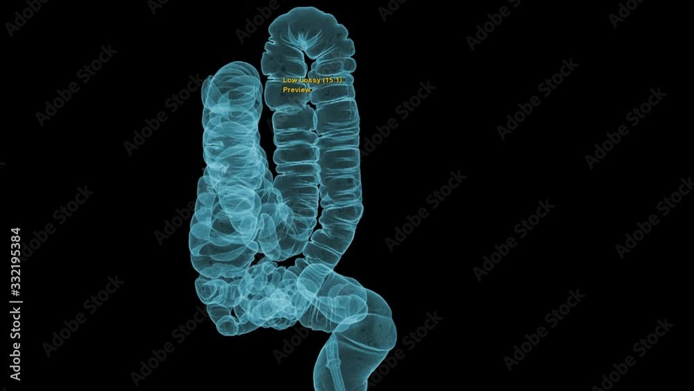 CT colonography or CT Scan of Colon 3D Rendering image showing ...
