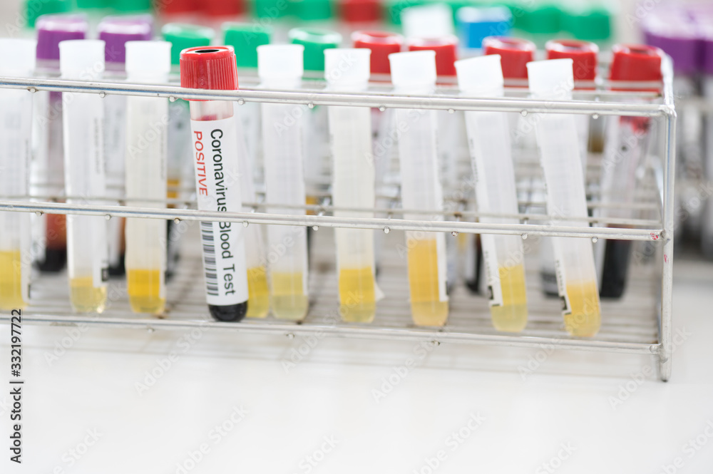 Blood test tube for laboratory analysis.Laboratory testing patient’s ...