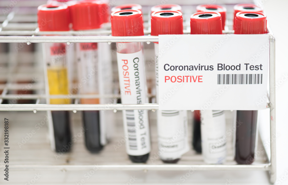 Blood test tube for laboratory analysis.Laboratory testing patient’s ...