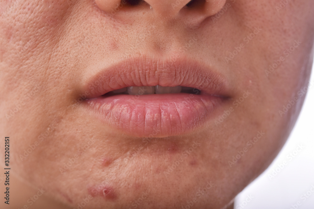 Skin problem with acne diseases, Close up woman face with dry lip mouth ...