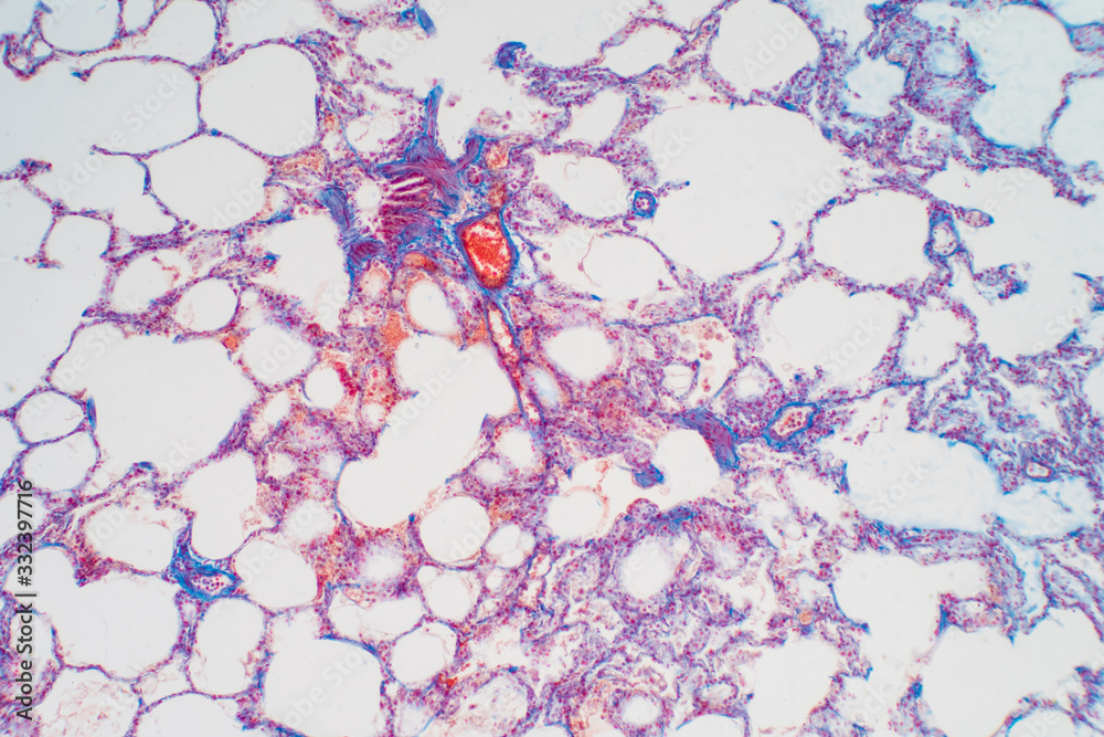 Human lung tissue under microscope, The lungs is organs of the ...
