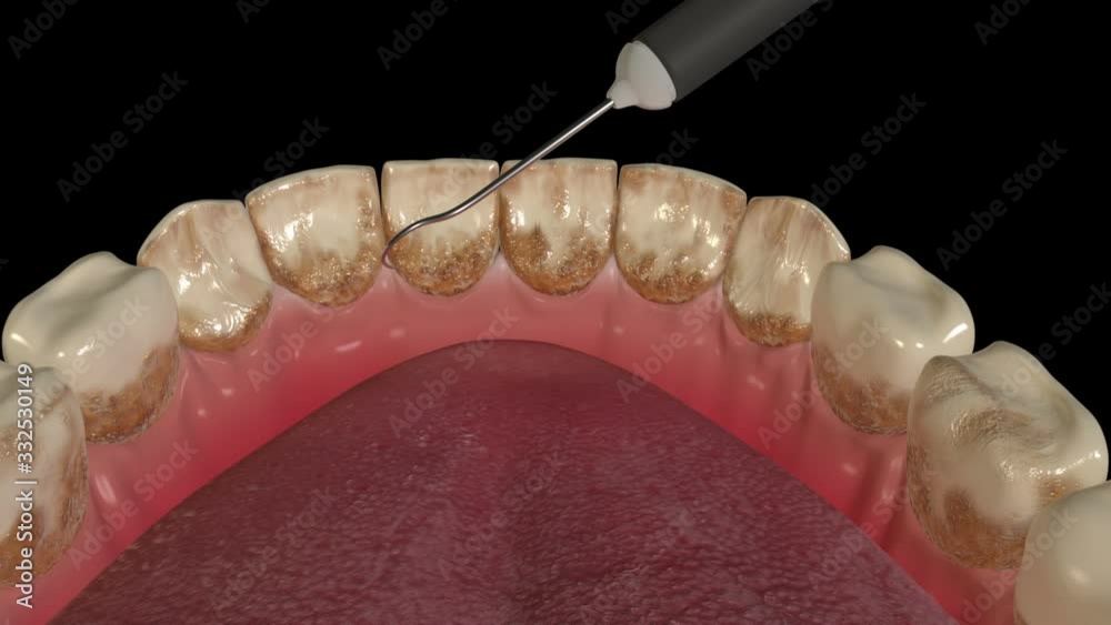 Dental Scaling Procedure Stock Video | Adobe Stock