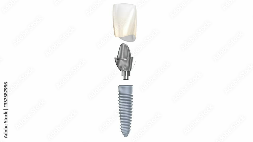Ceramic crown, custom implant abutment and implantat instalation ...