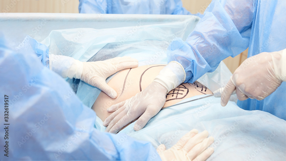 Surgery room. Belly surgery. Doctor mark liposuction area at tummy ...
