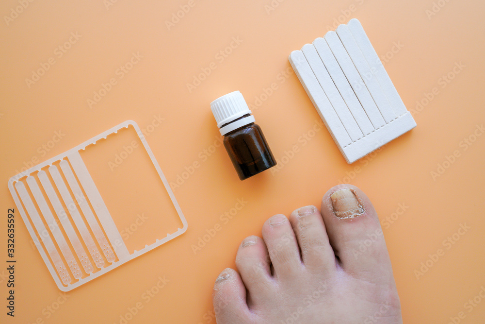A modern method of treating nail fungus with special medical varnish ...