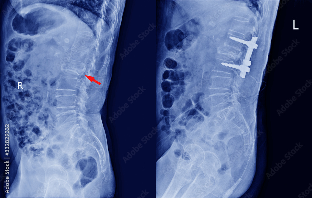 Medical X-ray Lumbar spine compression fracture Bulging of L1-2. Stock ...