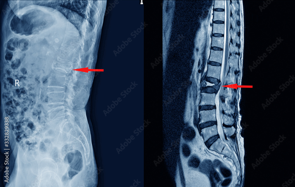 Medical X-ray Lumbar spine compression fracture Bulging of L1-2. Stock ...