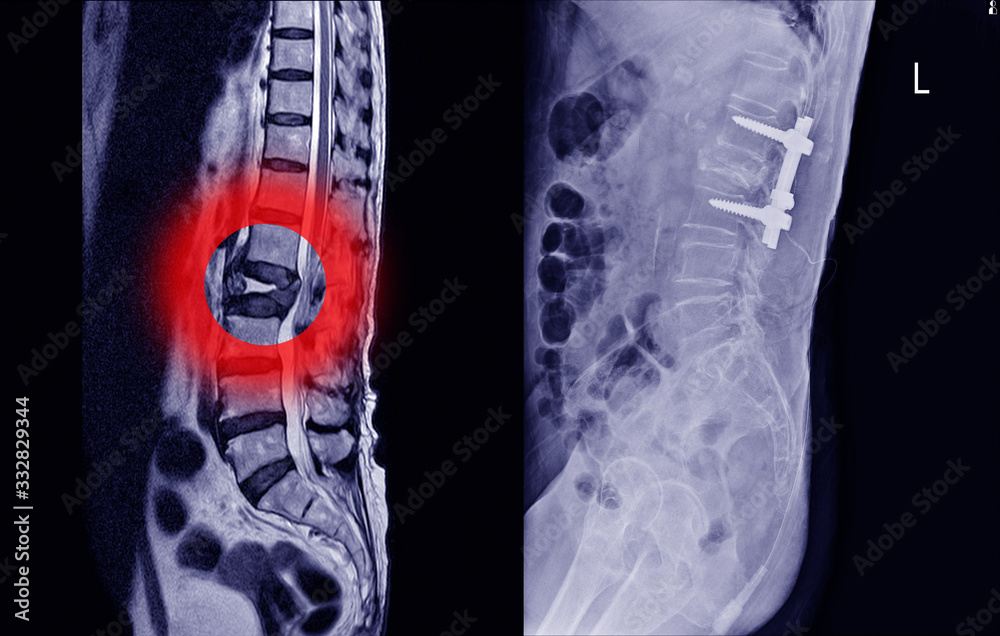 Medical X-ray Lumbar spine compression fracture Bulging of L1-2. Stock ...