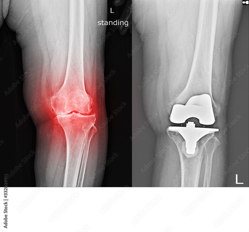 knee joint x-ray showing osteoarthritis and bone regeneration, with ...
