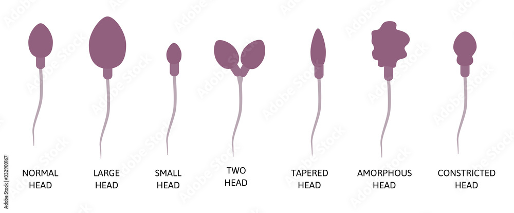 Spermogram and semen parameters, teratozoospermia, normal and abnormal ...