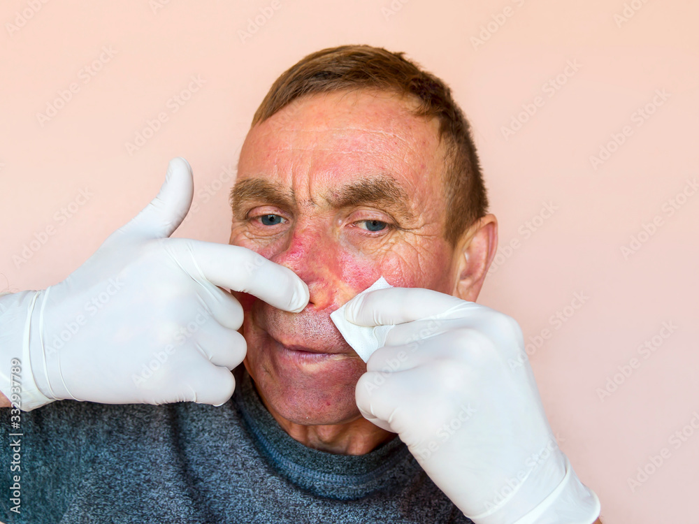 Demodecosis of the face. A man in gloves does the treatment of facial ...