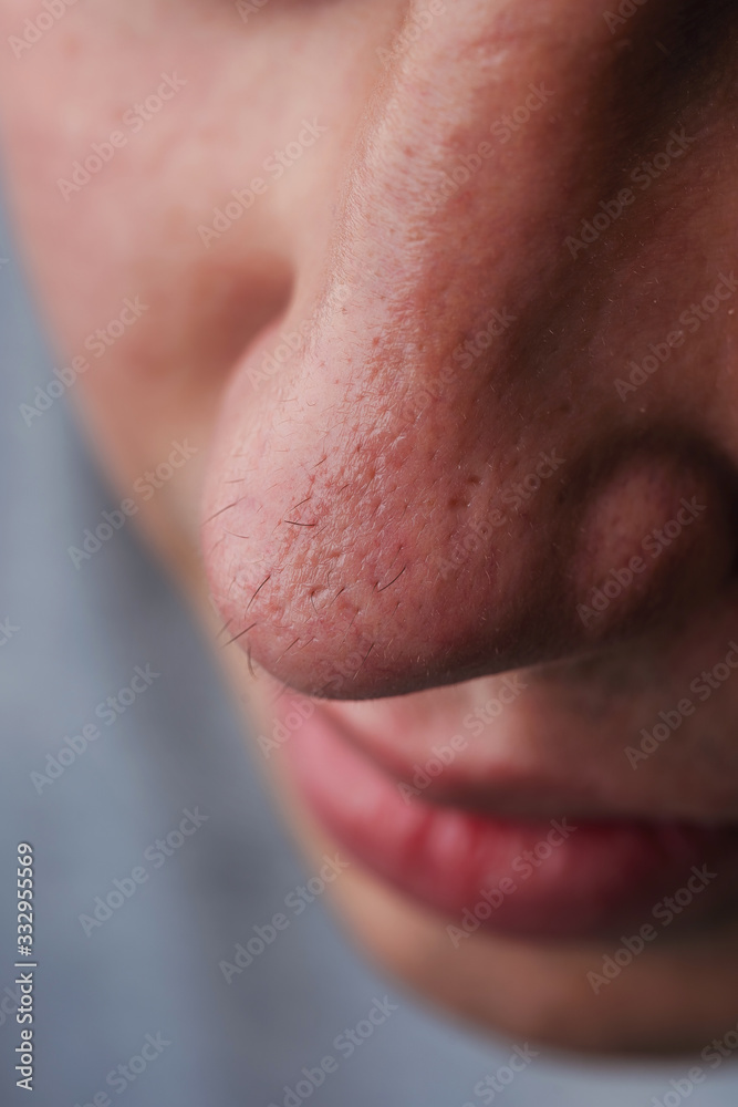 Man with nose hair close-up. Hair grows on the surface of the skin of ...