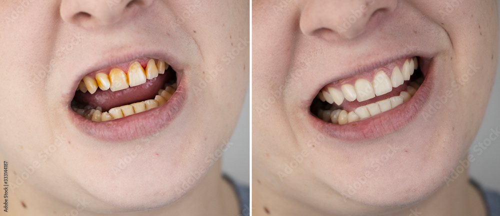 Foto de Teeth of a man before and after bleaching. The dentist removed ...