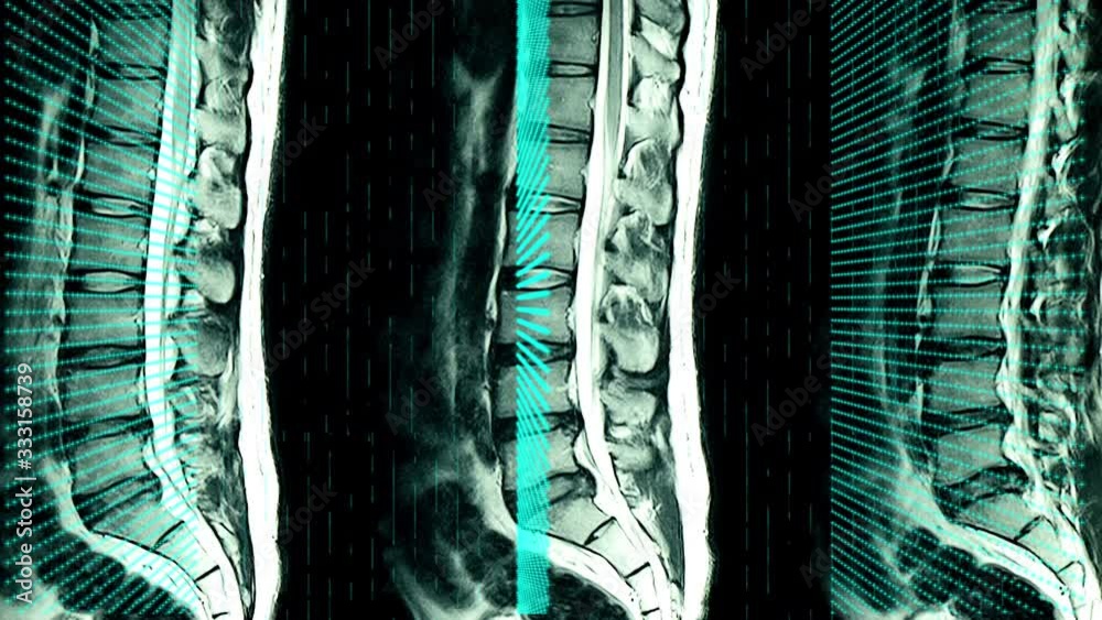 An MRI scan of lumbar and sacrum of a patient with herniated disc with ...