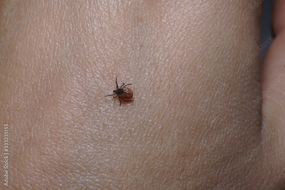 Female tick ( Ixodes scapularis) crawling on skin ready to bite Stock ...