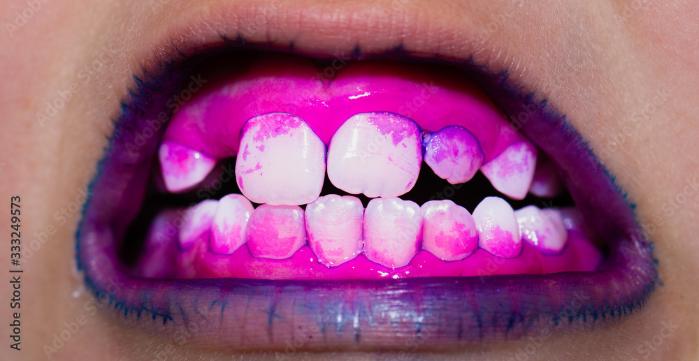 Plaque on teeth colored pink and purple. Stock Photo | Adobe Stock