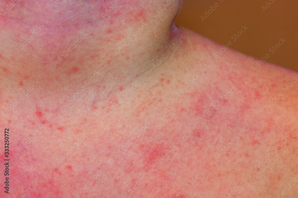Heat Rash Chest