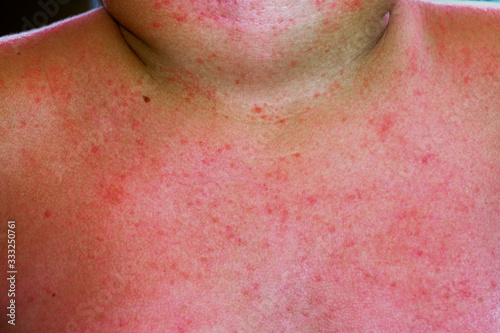 Heat Rash Chest
