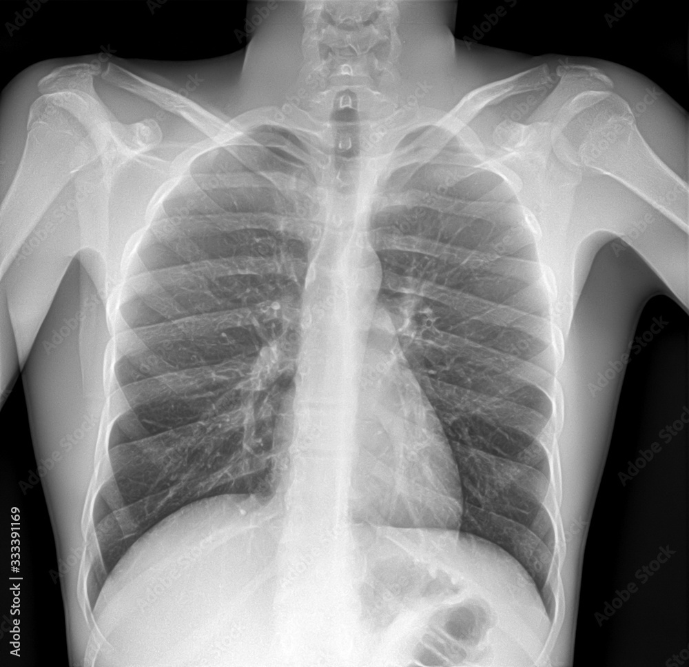 X-ray image of lung with pneumonia. Stock Photo | Adobe Stock