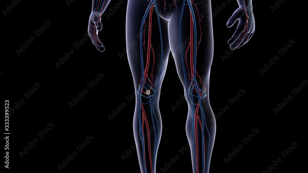 Biomedical animation of pulmonary embolism. a blockage in the artery of ...
