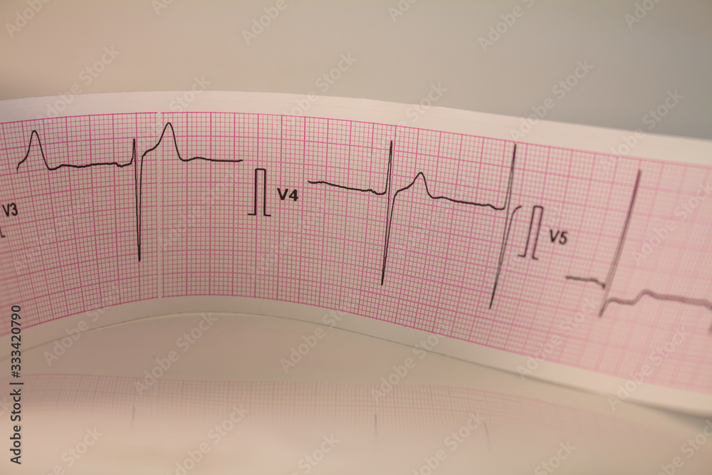 Electrocardiogram strip with heartbeat represented on paper. Graph ...