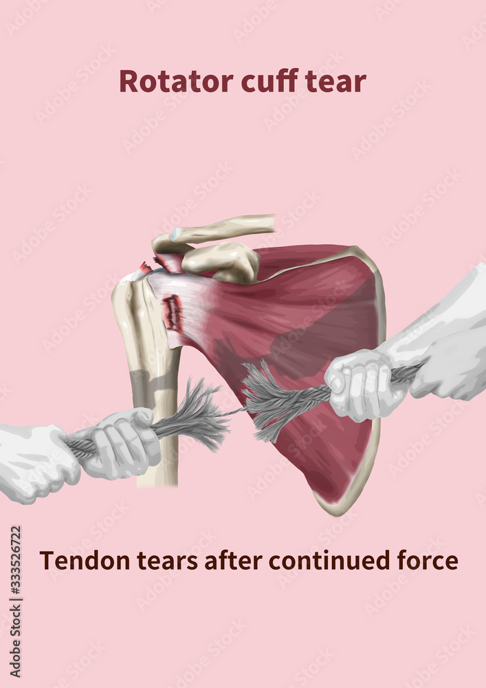 Rotator cuff tear illustration Stock Illustration | Adobe Stock