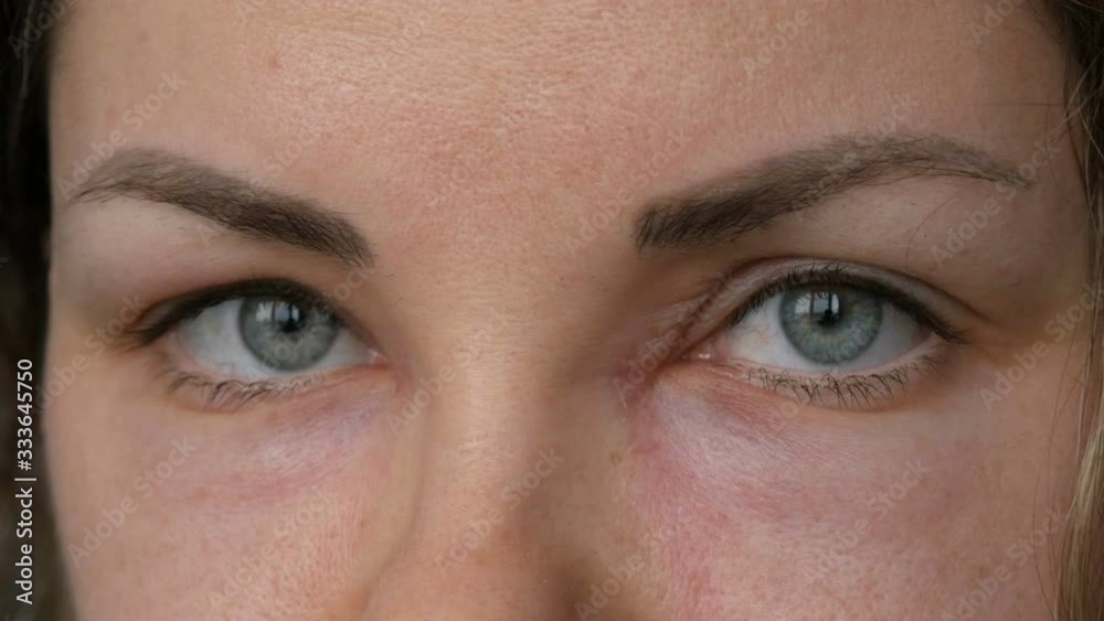 Young girl with an allergic reaction on the face and eyes, Quincke's ...