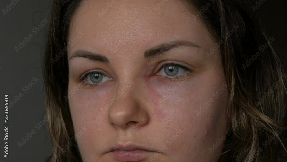 Young girl with an allergic reaction on the face and eyes, Quincke's ...