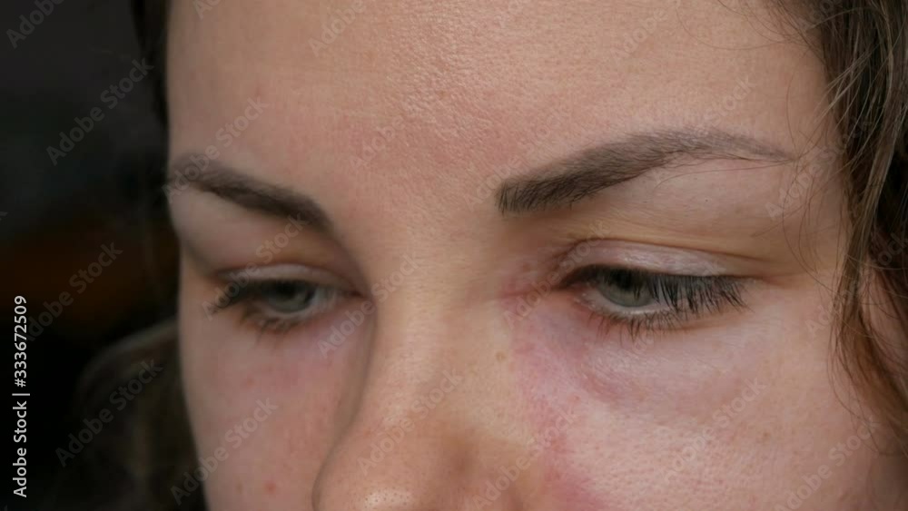 Vidéo Stock Young girl with an allergic reaction on the face and eyes ...